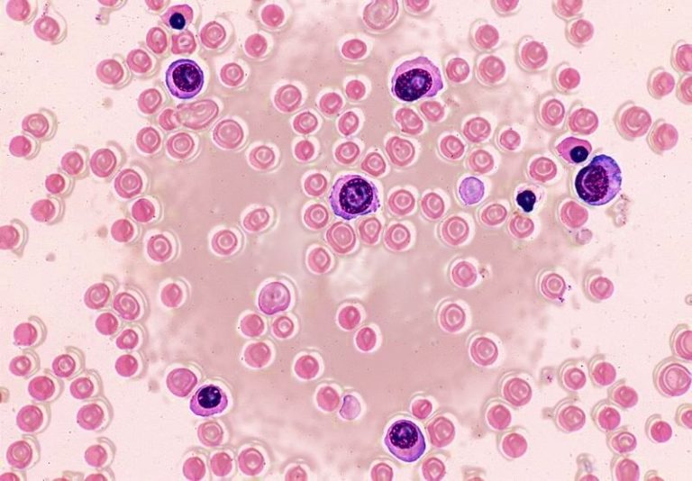 Neutropenic Fever And Empiric Therapy Epomedicine