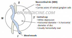 Glaucomatous Optic Disc Changes Made Simple | Epomedicine