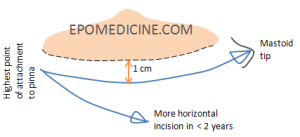 Approaches to Middle ear and Mastoid surgery | Epomedicine