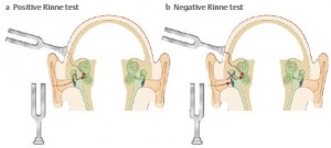 Hearing tests with Tuning fork | Epomedicine