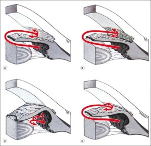 Glaucoma basics : Classification of Glacuoma | Epomedicine
