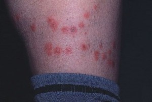 Dermatology Internship : 5 Common Skin Diseases Seen | Epomedicine