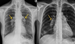 Chest Xray - Approach to hilum | Epomedicine