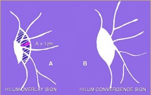 Chest Xray - Approach to hilum | Epomedicine