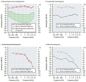 Pure Tone Audiogram and Interpretation | Epomedicine