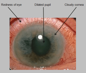 Sudden Vision Loss : Simplified Approach | Epomedicine