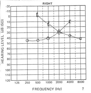 Pure Tone Audiogram and Interpretation | Epomedicine