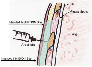 Chest Tube Insertion or Tube Thoracostomy | Epomedicine