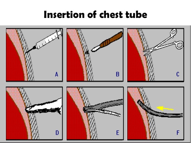 Chest Tube Insertion Or Tube Thoracostomy Epomedicine