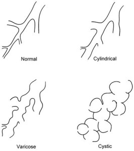 Bronchiectasis Revision Notes | Epomedicine