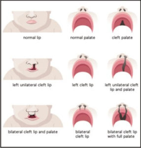 Face and Palate Development - Embryology made Easy | Epomedicine