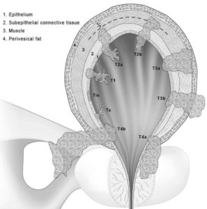 TNM and staging of Urinary Bladder Cancer Simplified | Epomedicine