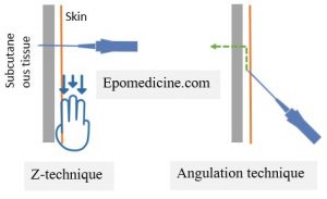 Ascitic Paracentesis : Practical Essentials | Epomedicine