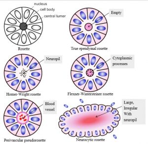 Rosettes in Pathology | Epomedicine