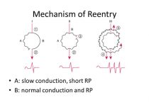 Short Approach to SVT and AVNRT management | Epomedicine