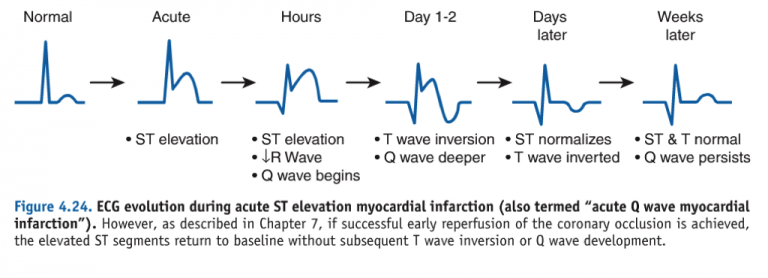 Acute STEMI Management - Mnemonic based approach | Epomedicine