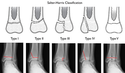 Salter Harris Classification For Physeal Fracture Mnemonic Epomedicine