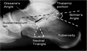 Lines and Angles in Orthopedics | Epomedicine