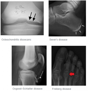 List of Osteochondritis of Different Bones | Epomedicine