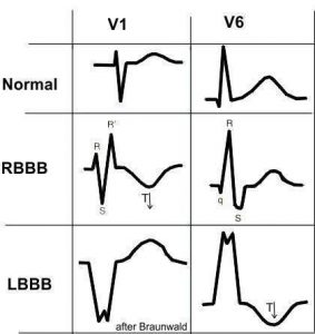 Bundle Branch Block : Mnemonic | Epomedicine