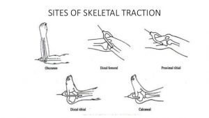 Skeletal Traction - Pin Insertion Sites | Epomedicine