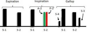 Heart Sounds - Clinically Explained | Epomedicine