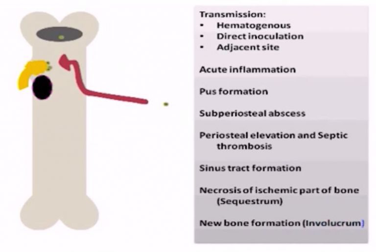 Pathophysiology of Osteomyelitis | Epomedicine