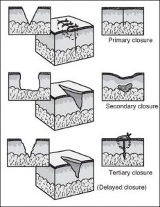 Timing of Wound Closure (Primary, Secondary, Tertiary) | Epomedicine