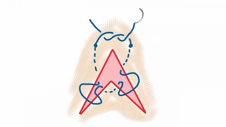 Corner Stitch | Epomedicine