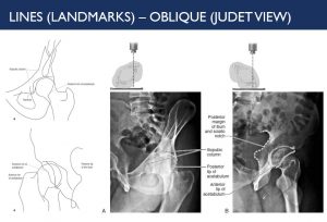 Pelvis X-ray : Simplified Approach | Epomedicine