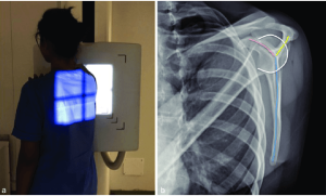Shoulder X-ray views | Epomedicine