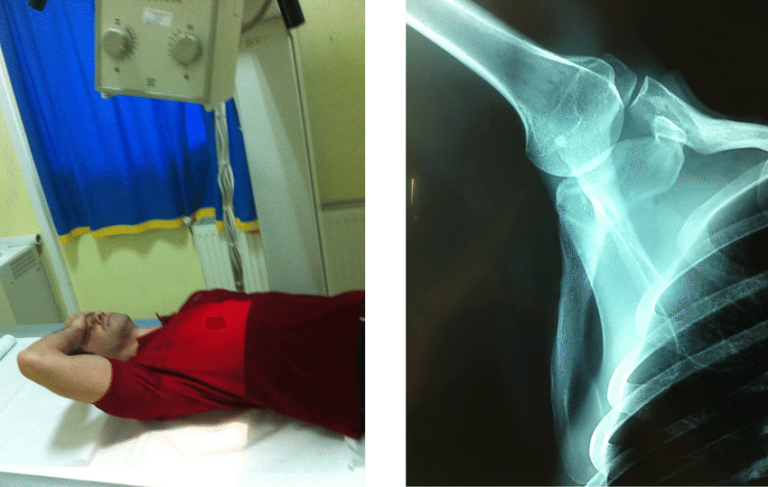 Shoulder X-ray views | Epomedicine