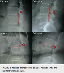 Diagnosis of Spinal Instability (White & Panjabi) : Mnemonic | Epomedicine