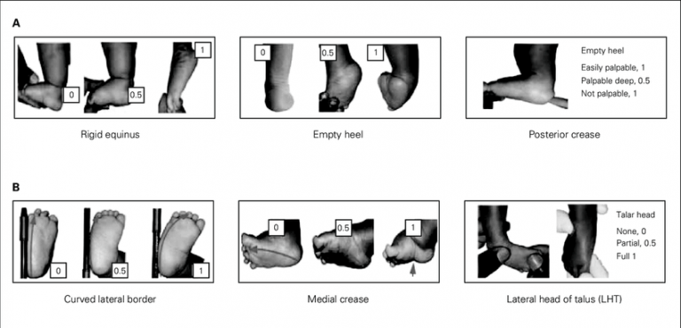 Pirani Score and Dimeglio Classification for Clubfoot Assessment ...
