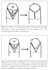 Volar V-Y advancement flap for fingertip amputations | Epomedicine
