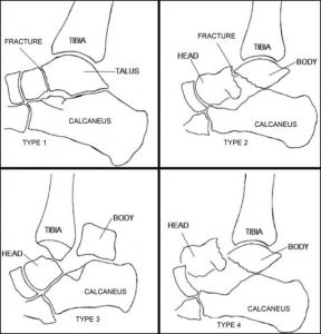 Hawkin’s Classification for Talus Fractures : Mnemonic | Epomedicine