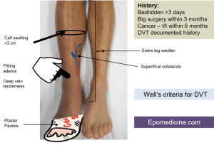 Well’s criteria for DVT with Mnemonic | Epomedicine