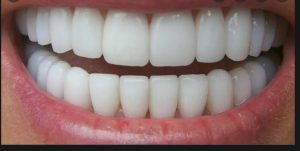 Understanding How Sugar Affects Your Teeth and Ways to Manage It ...