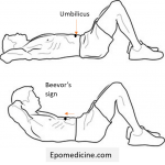 Beevor’s sign | Epomedicine