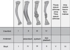 Congenital Pseudoarthrosis of Tibia (CPT) | Epomedicine