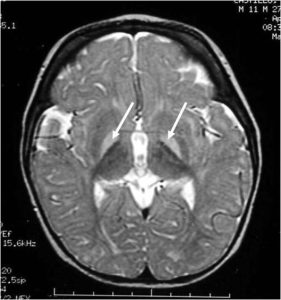 BIND score in severe hyperbilirubinemia | Epomedicine