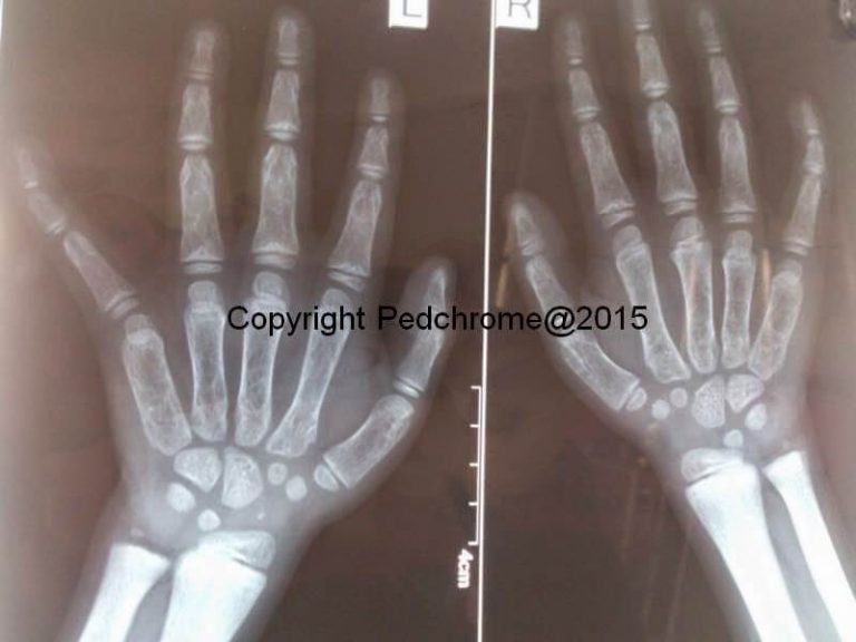 A case of child with Mucopolysaccharidosis : Hunter Syndrome | Epomedicine