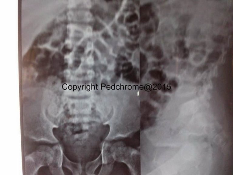 A case of child with Mucopolysaccharidosis : Hunter Syndrome | Epomedicine