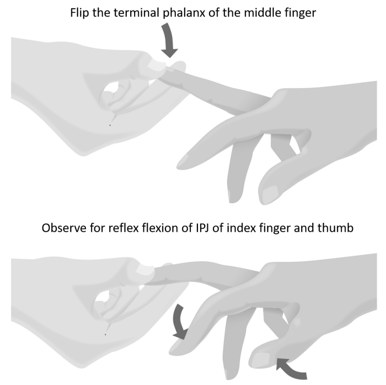 Hoffmann’s Sign | Epomedicine