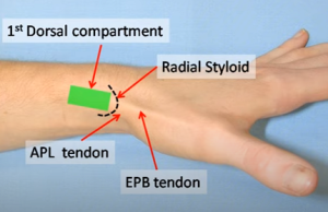 Injection technique for De Quervain’s Tenosynovitis | Epomedicine