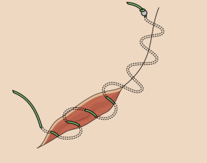 Running subcuticular suturing | Epomedicine