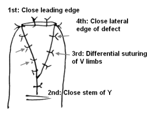 Volar V-Y advancement flap for fingertip amputations | Epomedicine