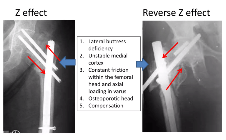 Z-effect and Reverse Z-effect in PFN | Epomedicine