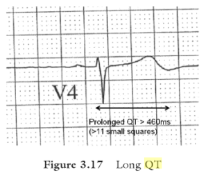 Prolonged QT Interval : Mnemonics | Epomedicine