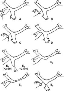 Bile duct injuries - Mnemonic | Epomedicine